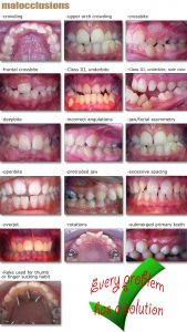 Common Orthodontic Problems – Yeh Orthodontics